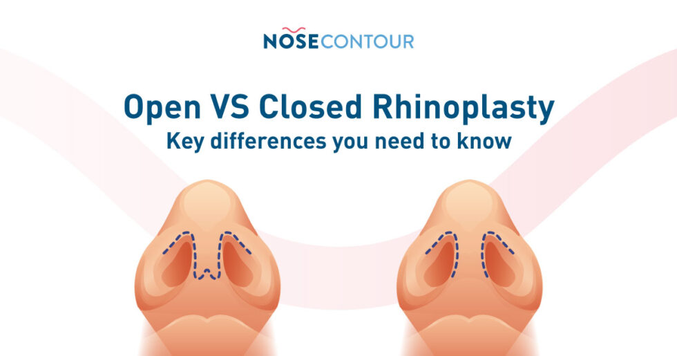 Open vs Closed Rhinoplasty: Key Differences, Pros, and Cons